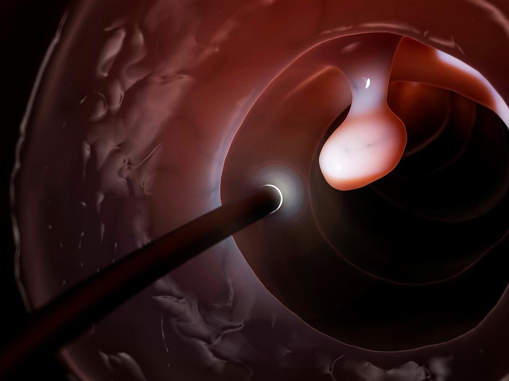 Colonoscopy is still the most recommended screening for colorectal ...