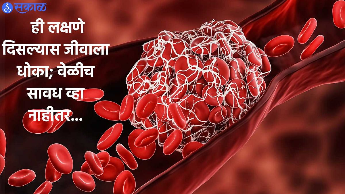 Blood Cloting Signs: शरीरात रक्ताच्या गुठळ्या होणे गंभीर! शरीरातील हे ...