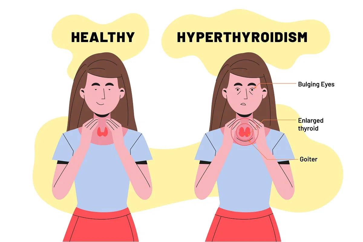 Signs And Symptoms Of Hyperthyroidism