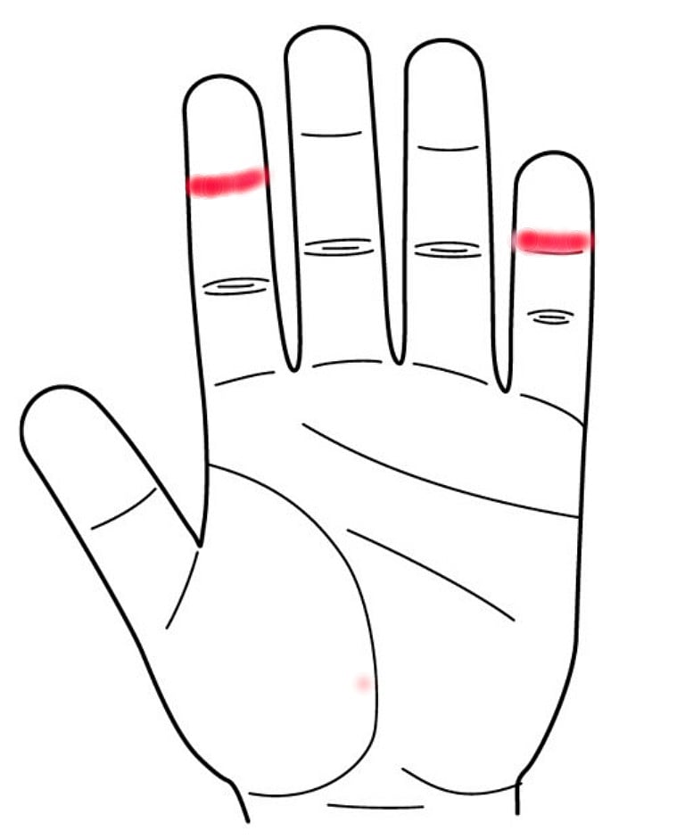 Managing carpal tunnel syndrome made easy with Sujok