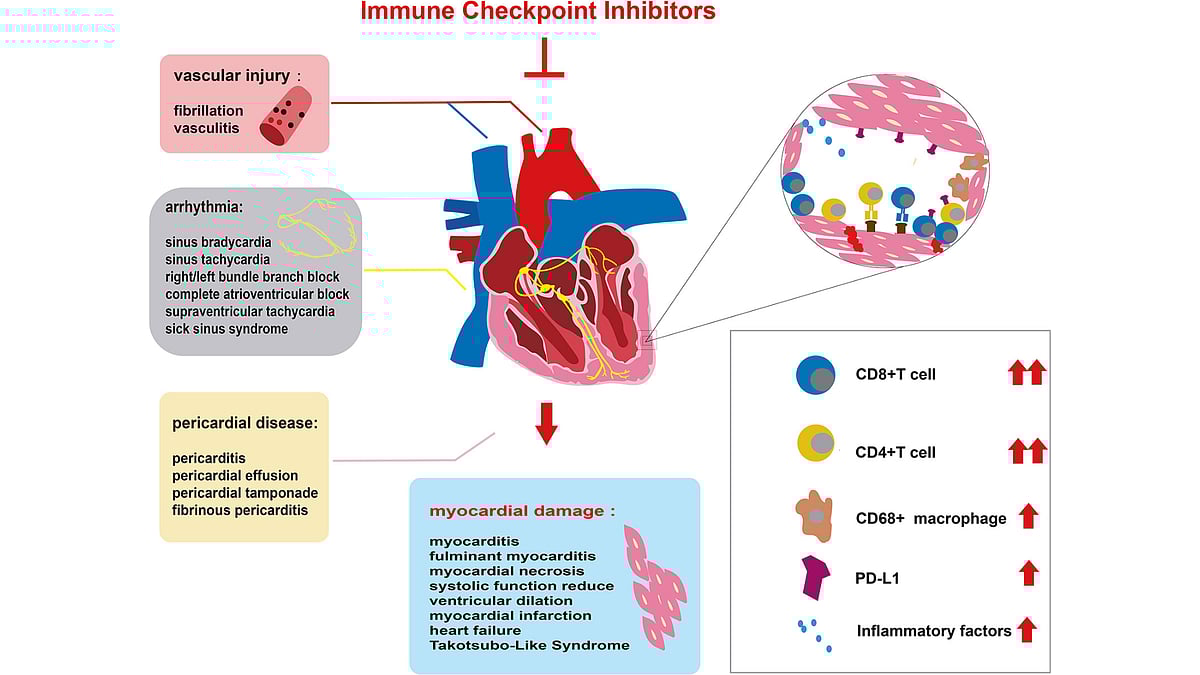 Specific immune cells cause myocarditis in cancer patients: Study