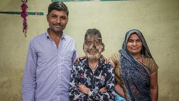 Madhya Pradesh: 17-year old boy suffering 'hypertrichosis' faces ...