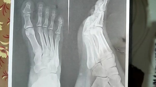 MP: Short on X-ray films, Gwalior hospital prints X-ray images on paper ...