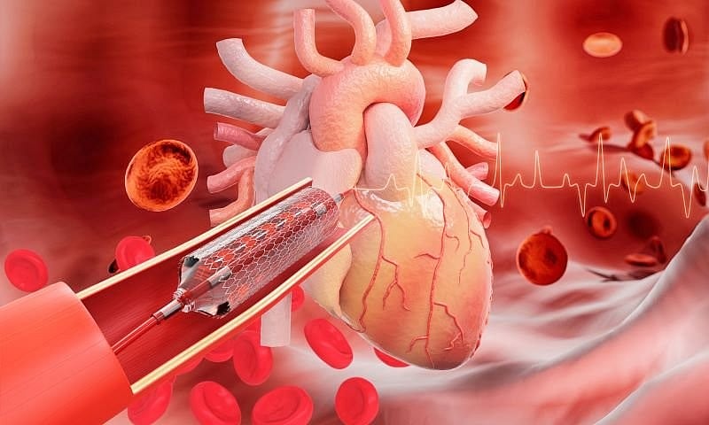 Intravascular Imaging Guidance of PCI Reduces Death, Heart Attack ...