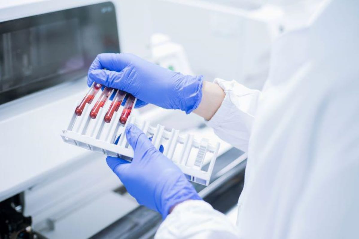 Multicancer Early Detection Test Reduces Late-Stage Diagnoses - Drugs ...