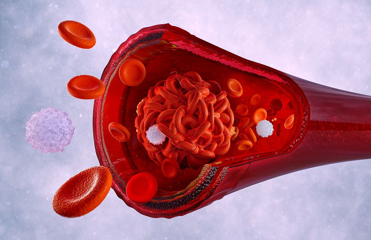 SIR: Endovascular Therapy Beneficial for Post-Thrombotic Syndrome ...