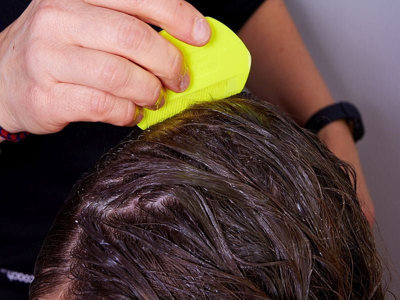 Topical Treatment for Head Lice Approved for OTC Use