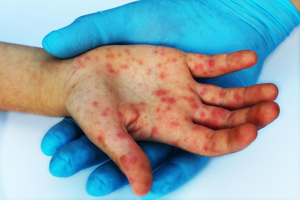 Rubella Elimination Likely to Be Achievable in All Countries