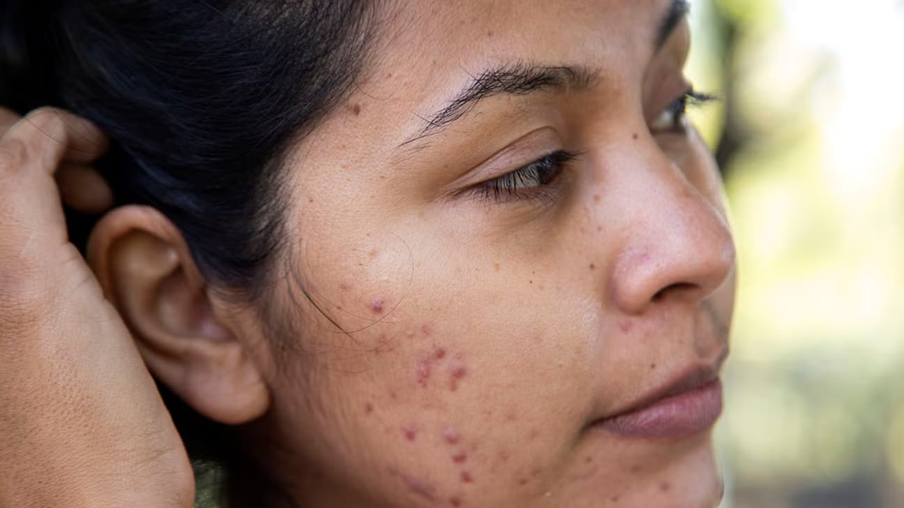 5 simple home secrets to get rid of pimples and scars permanently