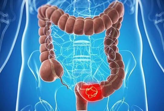 colon cancer and other cancers micro identification genomic sequencing ...