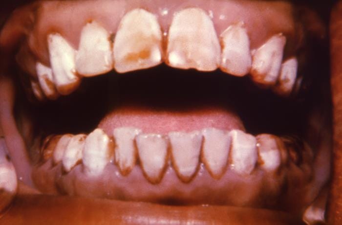 Is Fluoride a double edged sword?