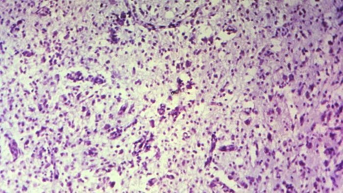 Have you ever heard about Babies born with Tails? What is Atavism?