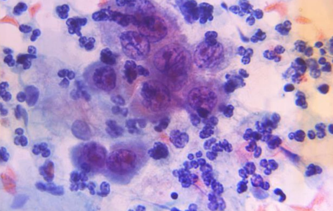 Cancer is uphill battle- support is necessary