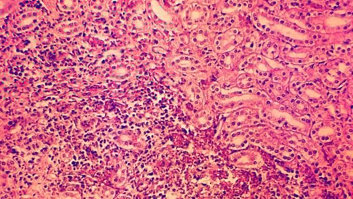 Risk of blood clots remains for almost a year after COVID-19 infection ...