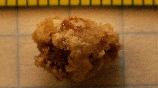 Kidney stones can be moved or blasted on awake patients