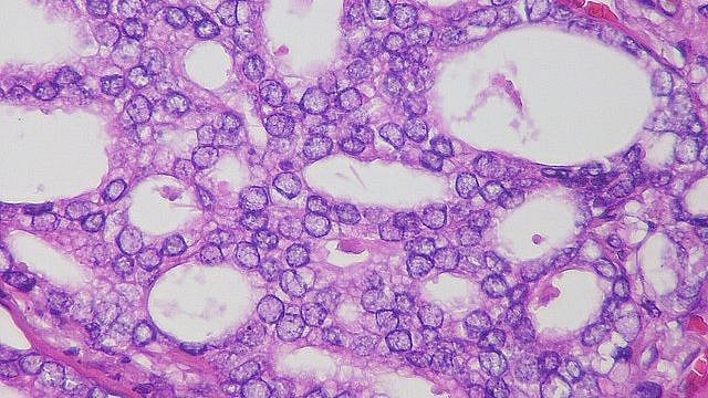 Study Reveals Pathways for Aggressive Prostate Cancer