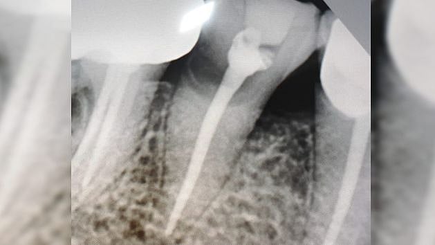Getting to the ROOT of your Root Canal Treatment