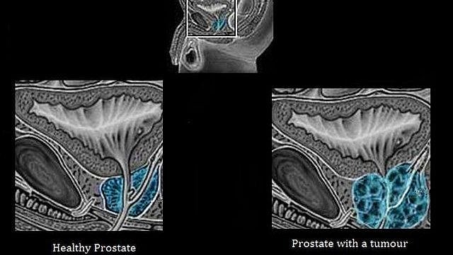 Study Reveals Pathways for Aggressive Prostate Cancer