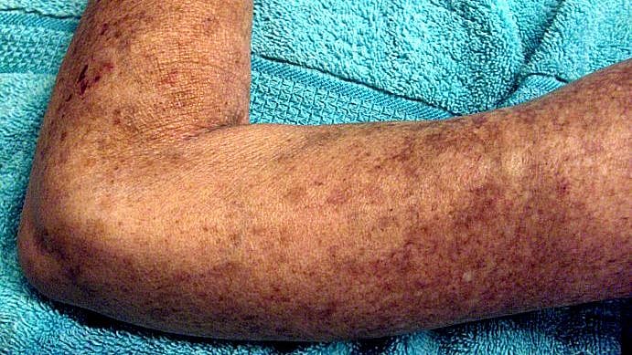 Tofacitinib shows potential in patients with Scleroderma