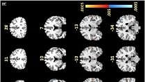 MRI Study Reveals Post-Treatment Lyme Disease Brain Abnormalities