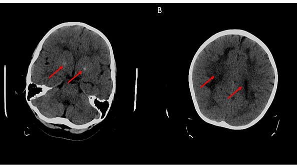 MRI Study Reveals Post-Treatment Lyme Disease Brain Abnormalities