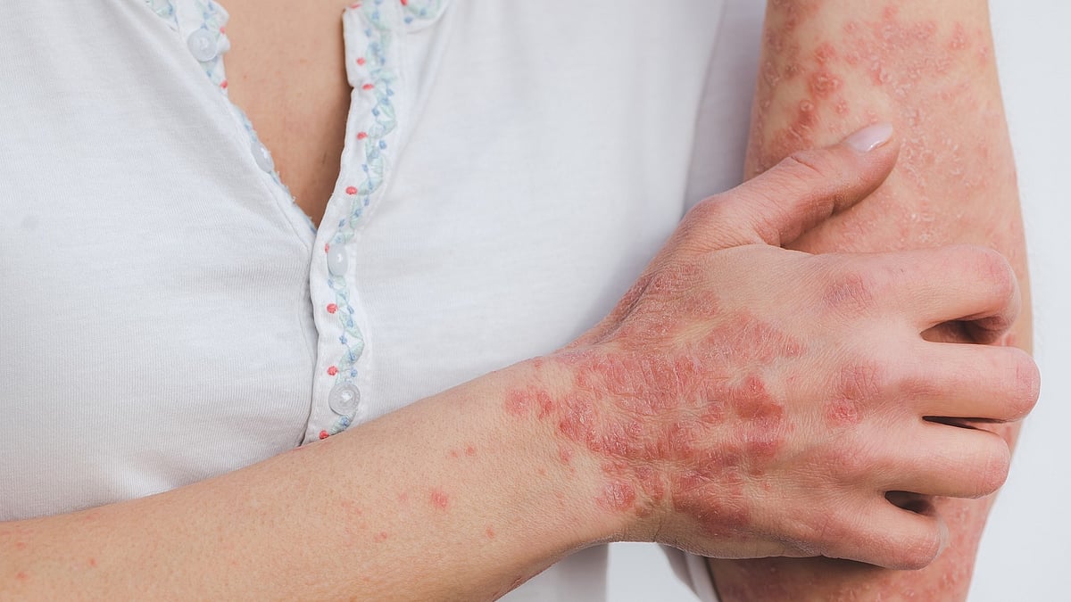 How UV Light Triggers Immune Activation & Disease Flares in Lupus