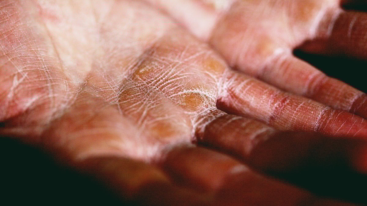 What is Contact dermatitis?