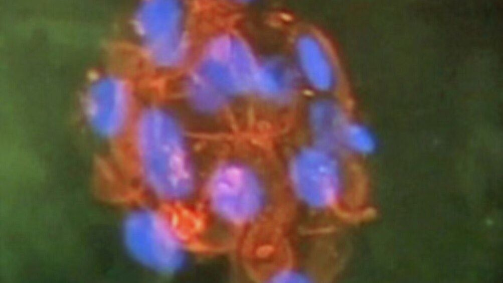 Independent subtype of idiopathic multicentric Castleman disease