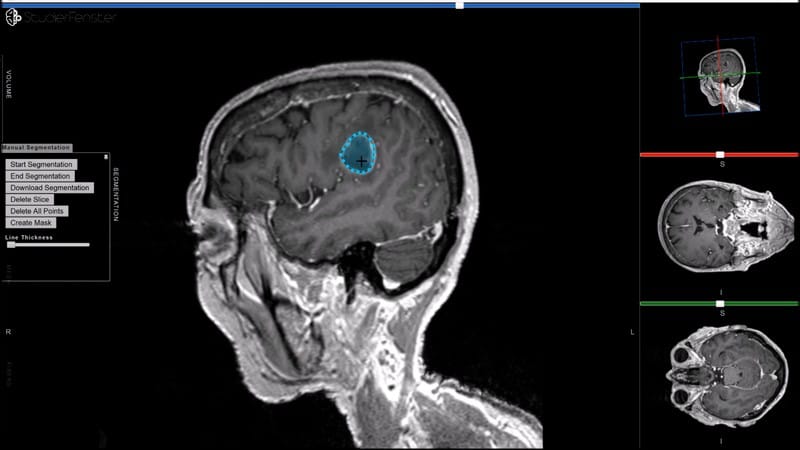 Pump implant safely delivers Chemo to brain cancer patients