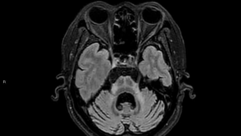 Delay neurodegenerative disorders with high-intensity exercise