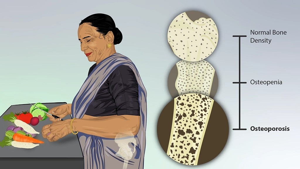 Osteoporosis- A Public Health Challenge for Indian Women