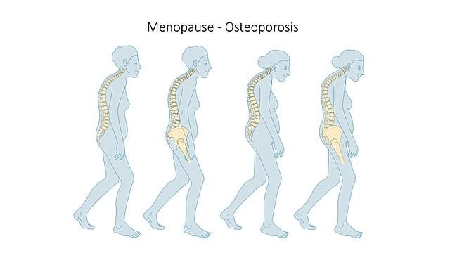Osteoporosis- A Public Health Challenge for Indian Women