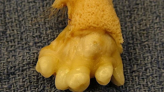 Dermoid Cyst Teeth