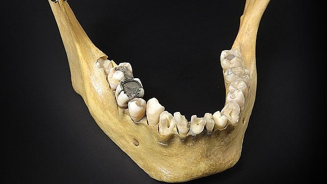 History and Evolution of Dental Filling Materials from Prehistoric to ...