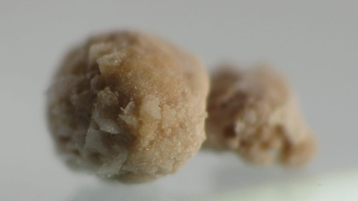 300 Kidney Stones Removed From 75-Yr-Old Farmer at Hyderabad's AINU