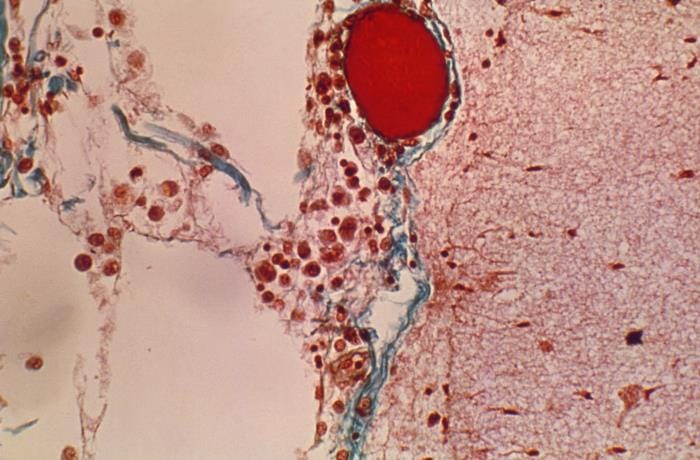 Warfarin and Heparin discovery