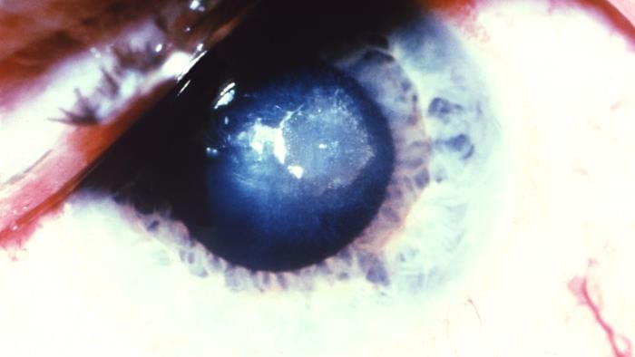 Treating Dry Age-Related Macular Degeneration: 6 Things to Know