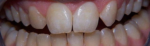 Dental Fluorosis: A Cosmetic Dental Concern