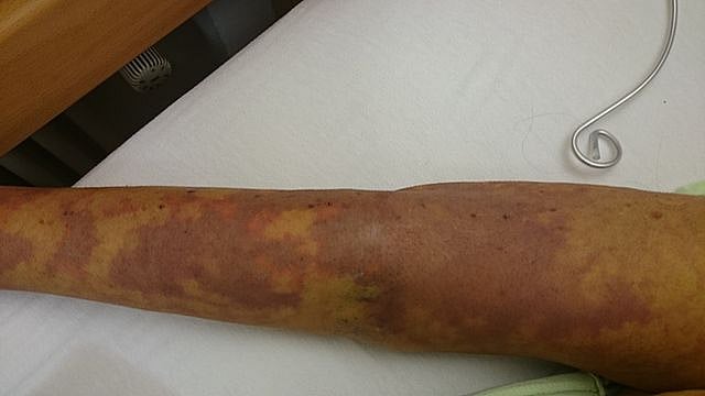 Sepsis – as Common as Cancer, as Deadly as a Heart Attack.