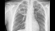 New tool makes it easier to diagnose tuberculosis in children
