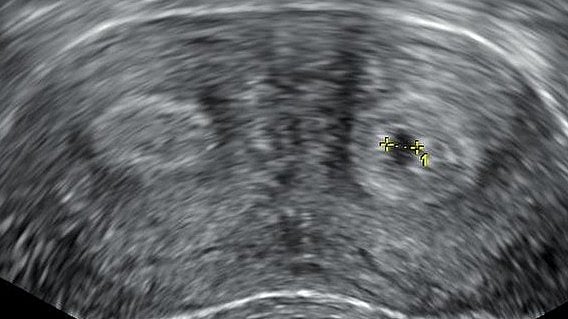 Very Rare Case: Alabama Woman with Double Uterus Pregnant in Both