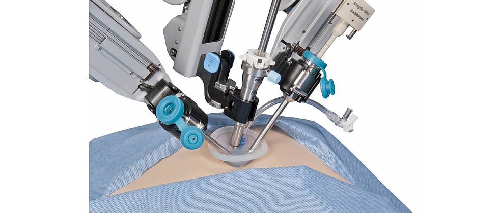 India’s 1st robotic surgery for renal hydatid cyst performed
