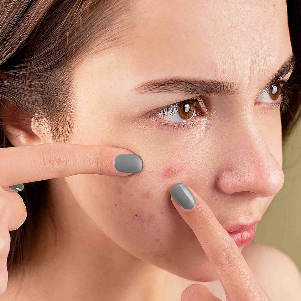 Here’s how adult acne differs from hormonal acne