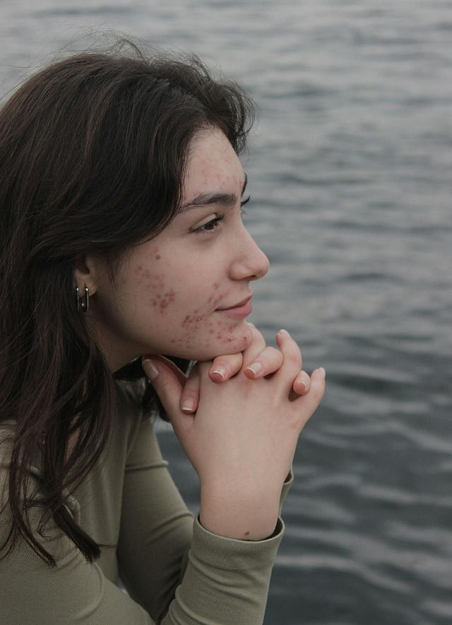 Mind-Skin connection: Impact of stress and anxiety on your skin