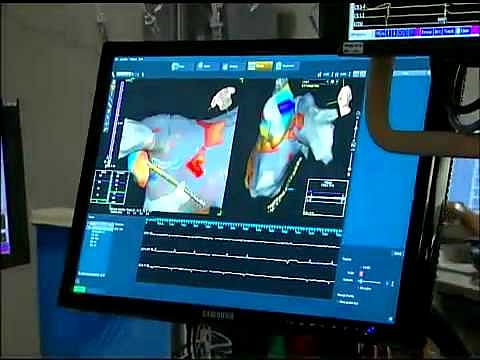 Fortis Memorial Research Institute Launches CATH LAB With India’s First ...