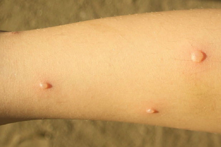 Everything you need to know about chickenpox and why more countries don ...